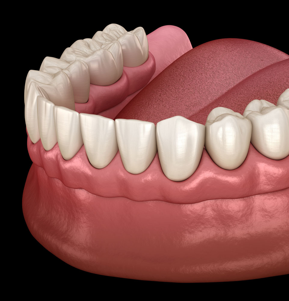 Full Mouth Restoration | Worthington, OH | Spectrum Dental and ...